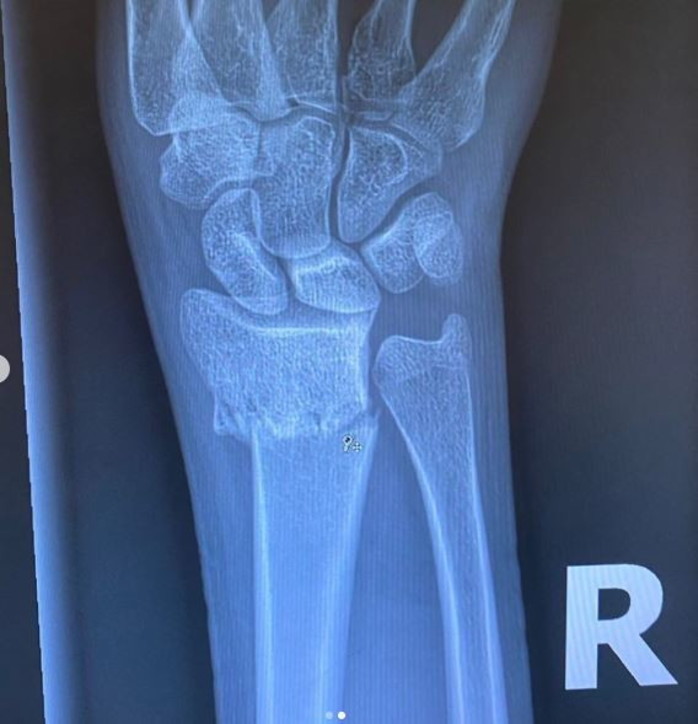 Ossa rotte e fasciature, i vip infortunati durante il lockdown - Tgcom24