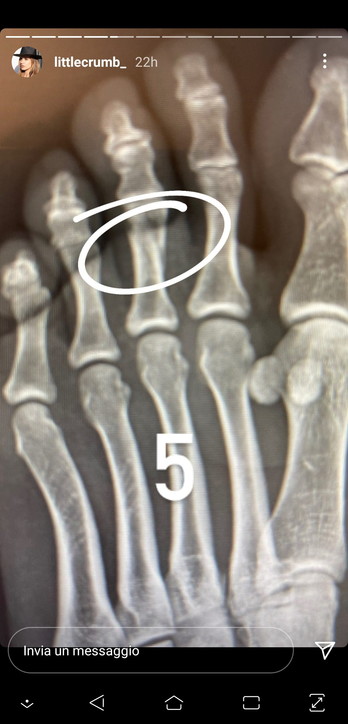 Infortunio per Elisabetta Canalis: dito del piede rotto, ecco come ha ...